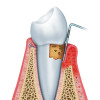 Stages of Gum Disease | Finley Periodontics