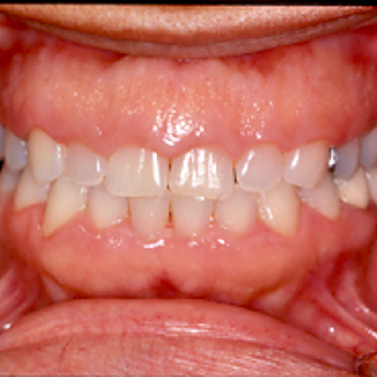 Gum Grafting | Lafayette, LA | Finley Periodontics